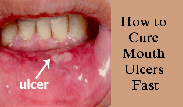 How to Treat Oral Ulcers: Everything You Need to Know